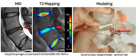 Image result for How to View MRI Disc