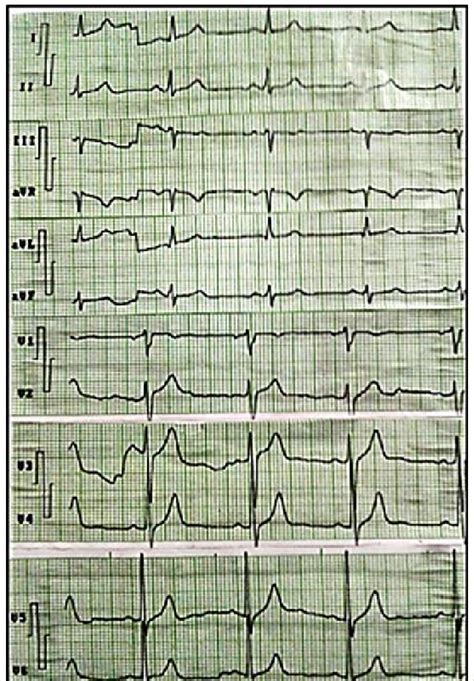 Image result for ECG 12 Derivaciones Normal