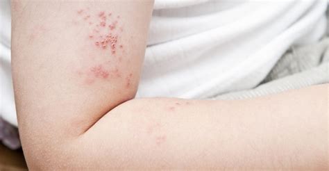 Shingles Symptoms, Causes, Risk Factors, and Natural Treatments - Well ...