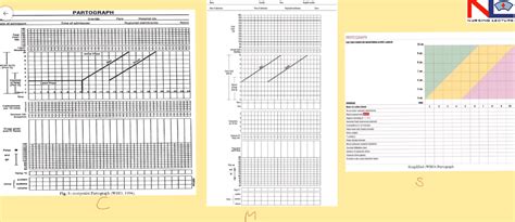Image result for Types of Partograph