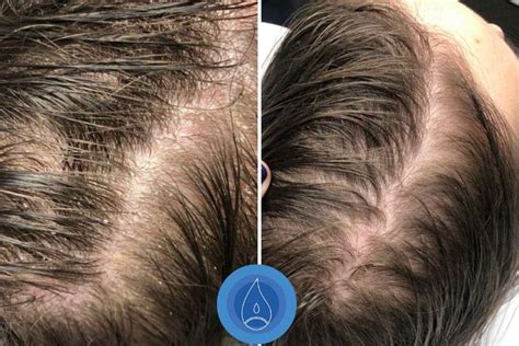 Image result for Treating Seborrhea