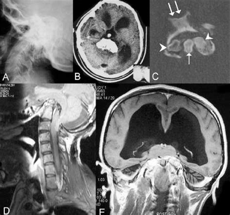 Image result for X-Rays for Basilar Invagination