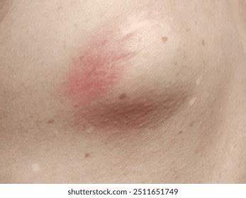 Image result for Exploding Cyst and Abscess