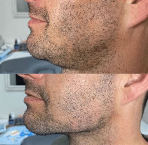 Image result for Thread Lifting Face