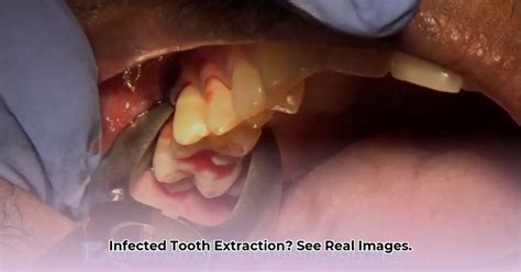Image result for Infected Tooth Extraction