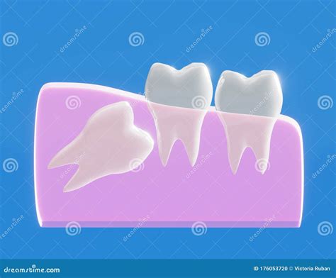 Image result for Wisdom Tooth Overlap