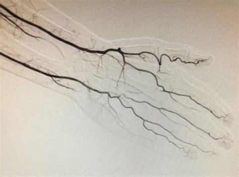 Image result for Hand Angiogram