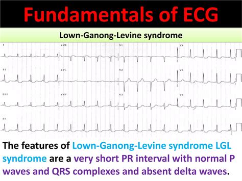 Image result for PR Interval Abnormalities