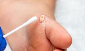 Image result for How to Remove Calluses Forever