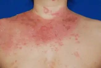 Image result for Types of Pustular Psoriasis