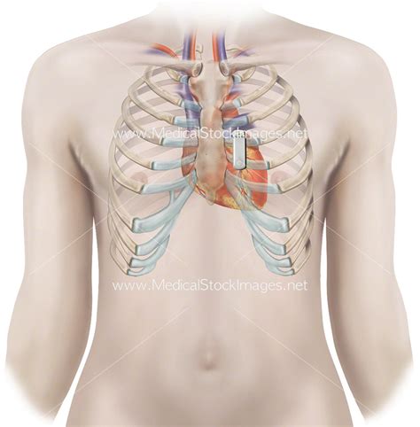 Image result for Loop Recorder Surgery