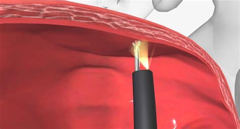 Image result for Transurethral Procedure