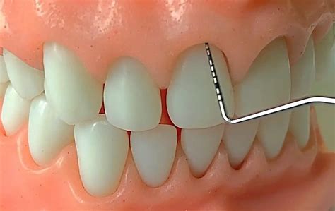 Image result for How to Perio Chart