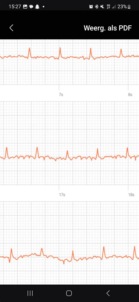 Image result for Atrial Flutter Loop Recorder