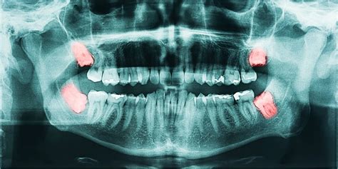 Image result for Impacted Wisdom Tooth Extraction