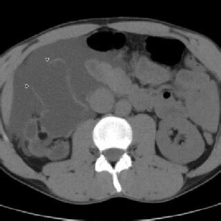 Image result for Delayed Phase CT Urogram