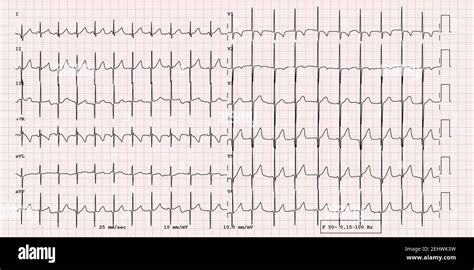 Image result for Normal EcG