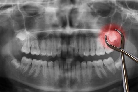 Image result for Wisdom tooth Extraction