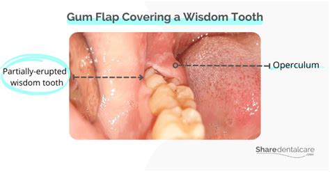 Image result for Wisdom Tooth Overlap