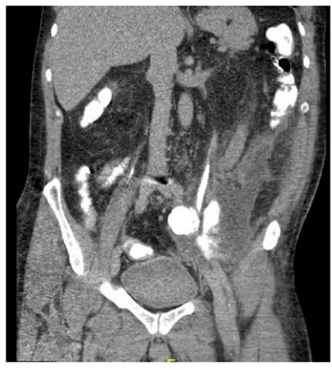 Image result for Volume-Rendered CT Urogram