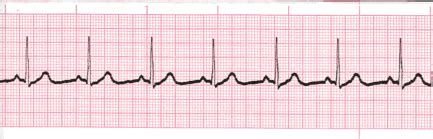 Image result for Paediatric PR Interval