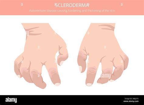 Image result for Scleroderma Skin