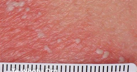 Image result for Types of Pustular Psoriasis