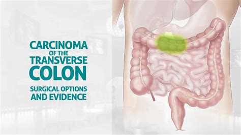 Image result for Colon Channel TCM