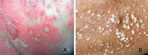 Image result for Types of Pustular Psoriasis