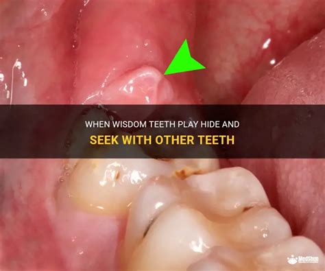 Image result for Wisdom Tooth Overlap