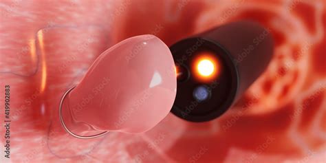 Image result for Colonoscopy Clips for Polyps