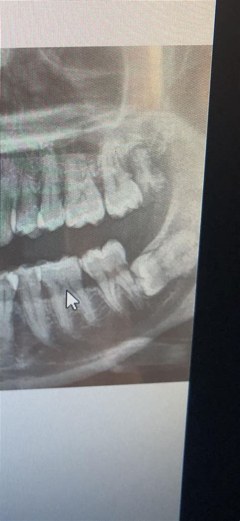 Image result for Impacted Wisdom Tooth Extraction