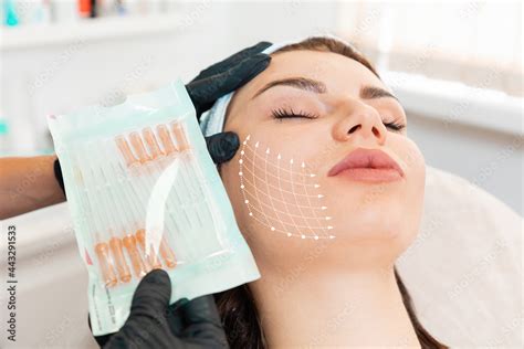 Image result for Thread Lifting Face