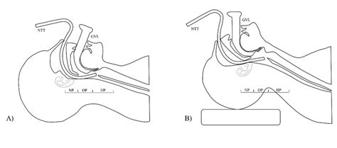 Image result for Intubation Position