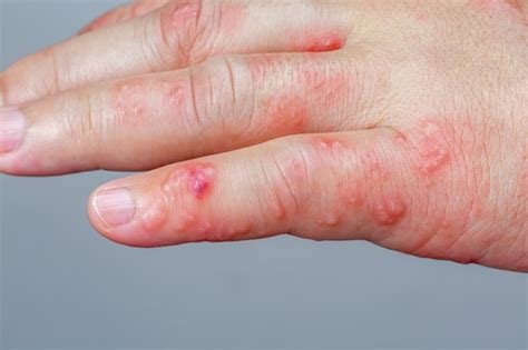 Premium Photo | Shingles, zoster or herpes zoster symptoms on arm