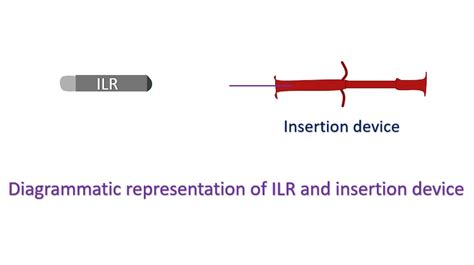 Image result for Injectable Loop Recorder