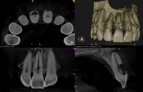 The Challenges Surrounding Tooth Resorption – Root Canal Specialty ...