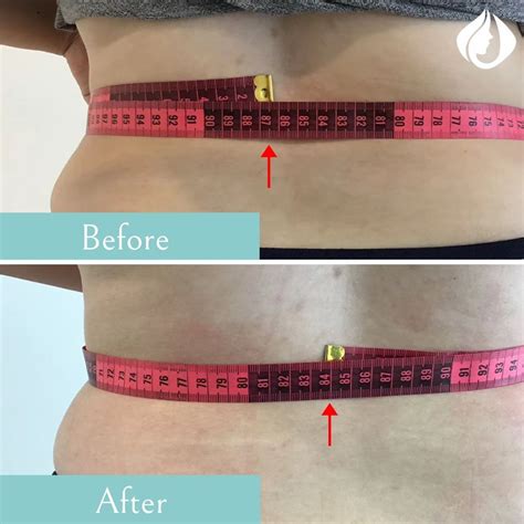 Image result for Body Contouring Work