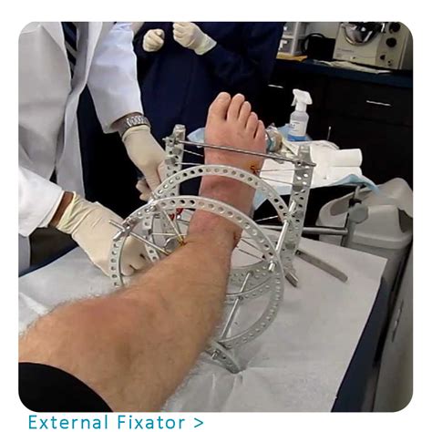 Image result for External Fixator Surgery