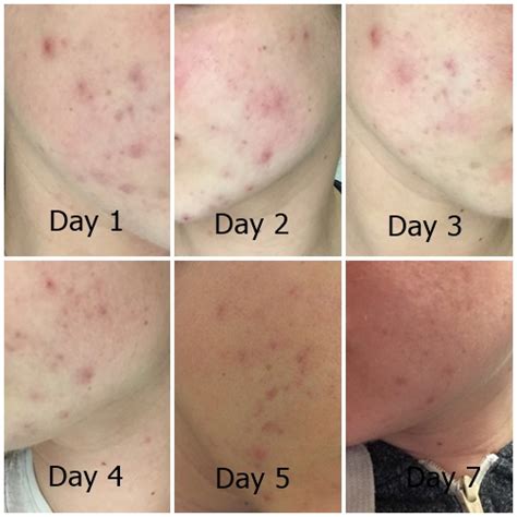 Image result for Baking Powder for Skin