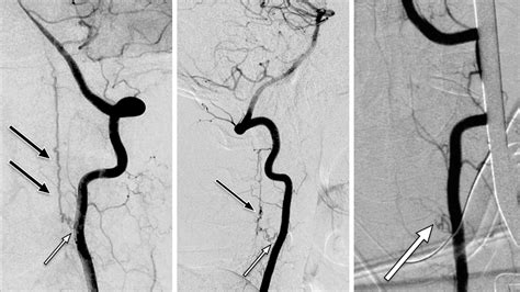 Image result for Spinal Angiogram