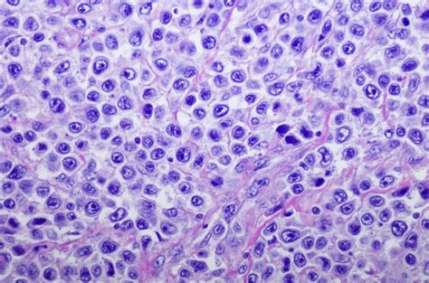 Image result for Diffuse Large Cell Lymphoma