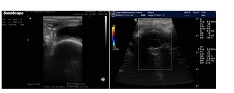 Image result for EPB Ultrasound Linear Array