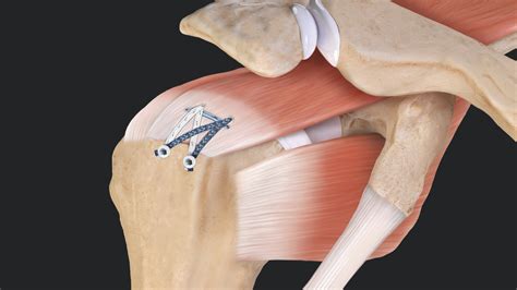 Image result for SpeedBridge Rotator Cuff