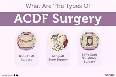 Image result for ACDF Surgery Is Serious