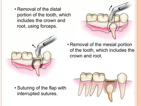 Image result for Principles of Tooth Extraction