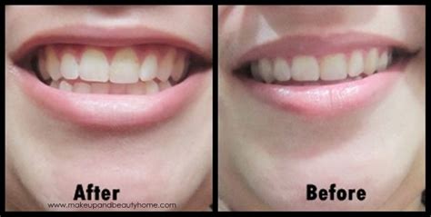 Colgate Visible White Toothpaste Review, Before & After Pics | Colgate ...