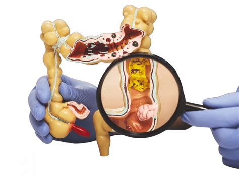 Image result for Colon Open Cancer Removal