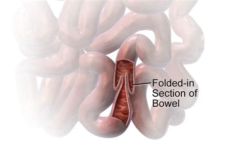 Image result for Intussusception