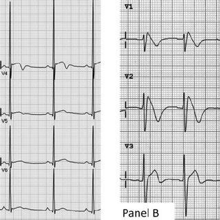 Image result for AV Block PR Interval